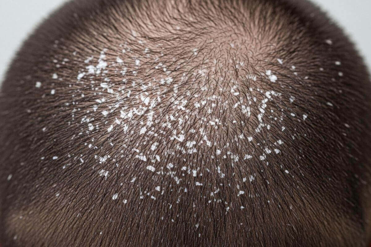 How Do I Get Rid of Dry Flaky Hair Naturally: 8 Simple Solutions
